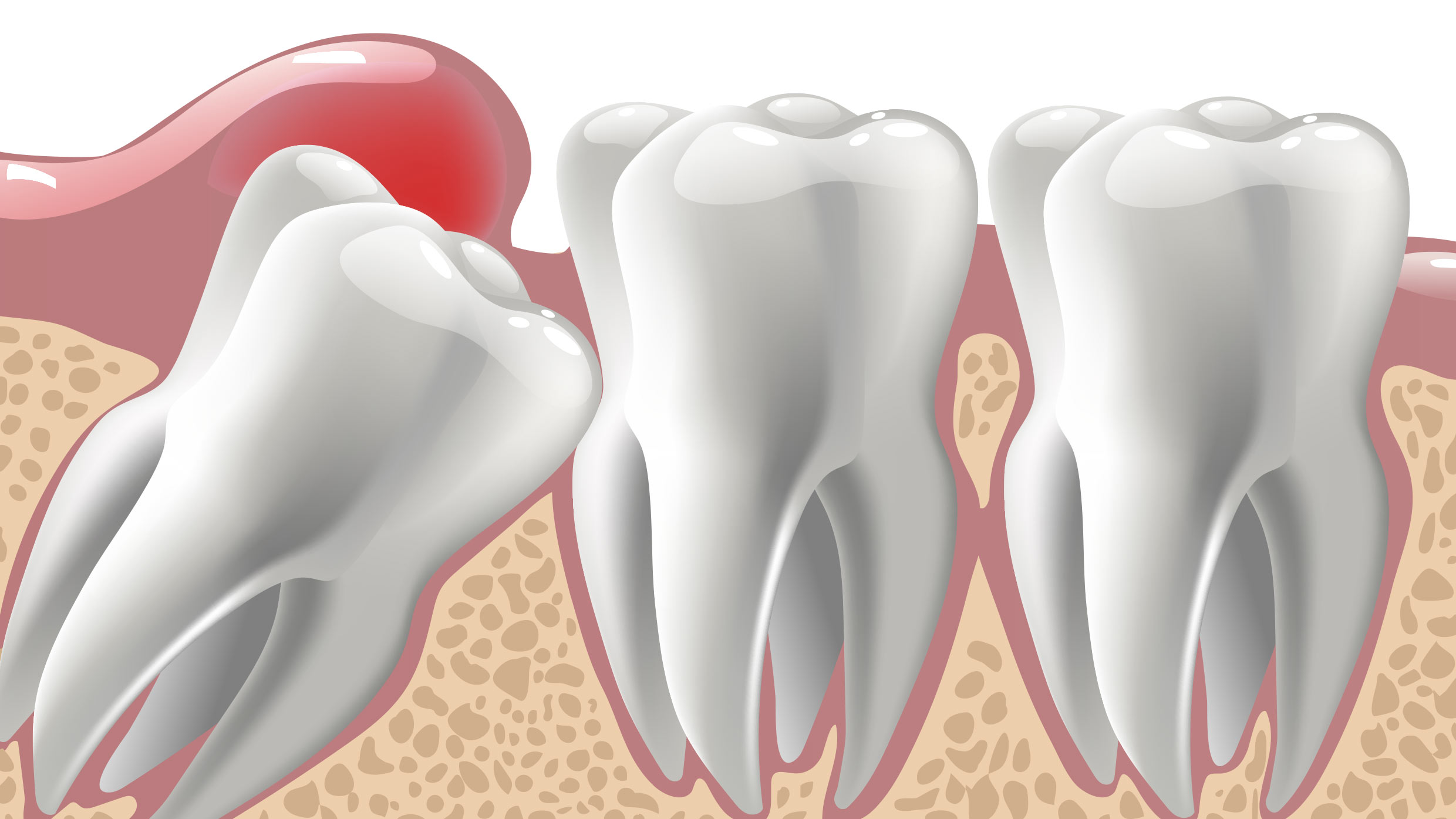 Inclusione dentale: come riconoscerla e in che modo rimediare - Caredent